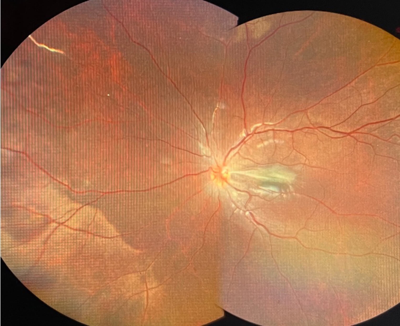 Collaborative Case #006: Red Tied - Modern Optometry