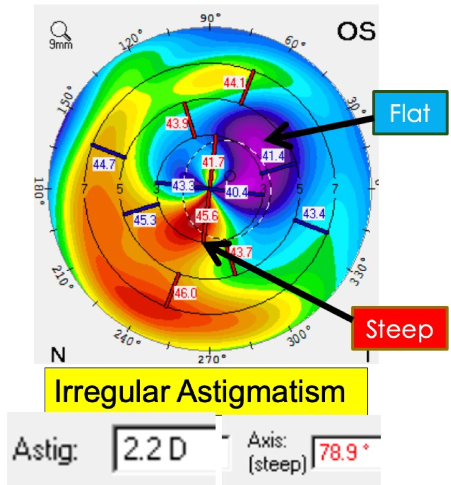 Collaborative Case #008: IOL Selection Challenge - Modern Optometry