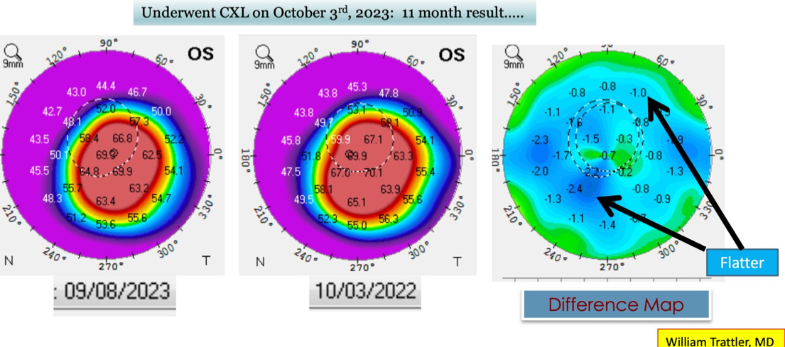 Collaborative Case #009: Two Cases of Keratoconus - Modern Optometry