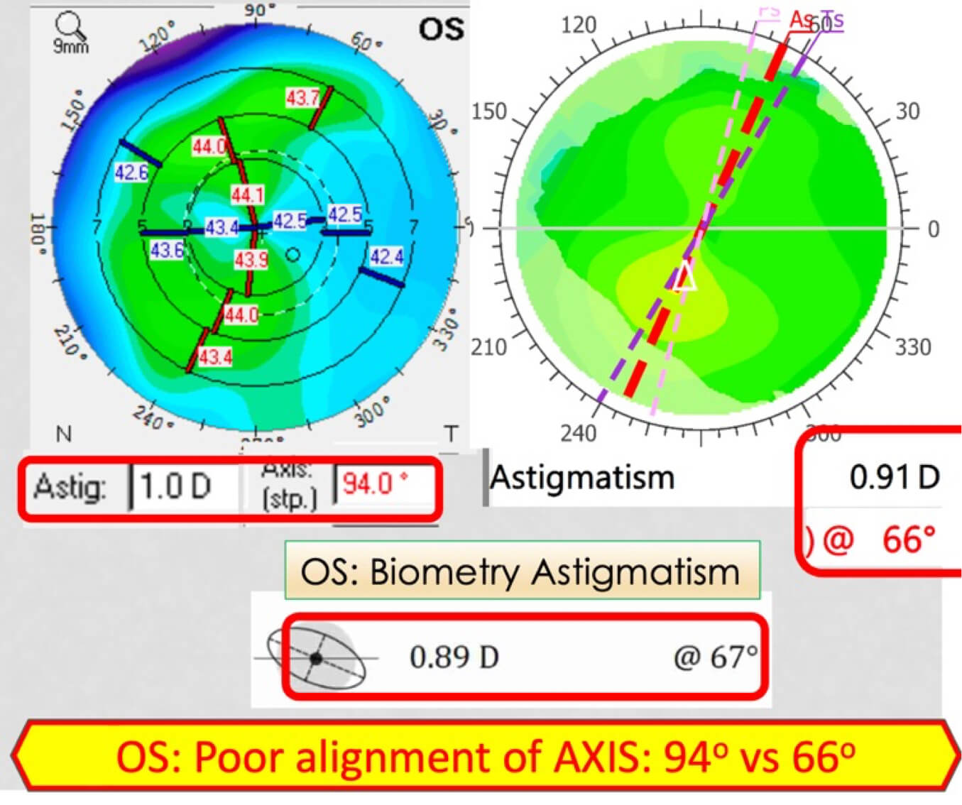 Collaborative Case #010: Managing the Unhappy Presbyopic IOL Patient ...