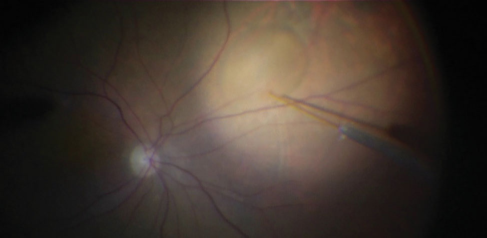 Surgical Drug Delivery Roundup - Retina Today