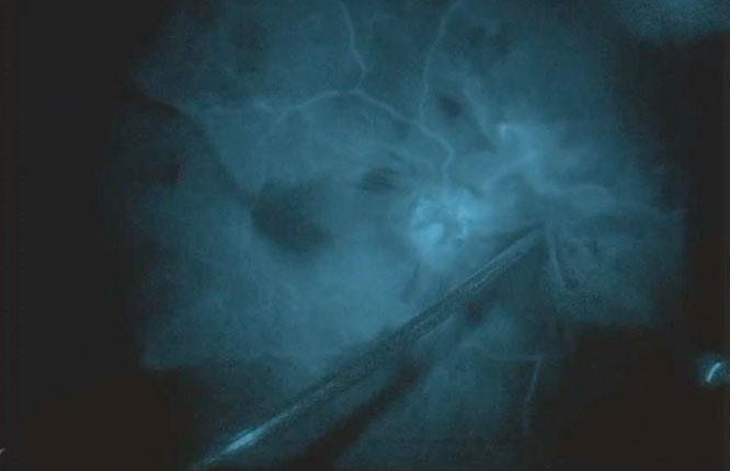 The Ins and Outs of Intraoperative FA - Retina Today