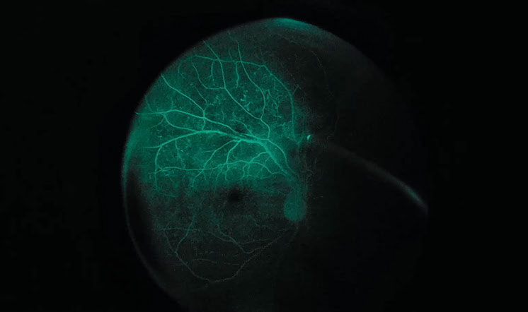 The Ins and Outs of Intraoperative FA - Retina Today