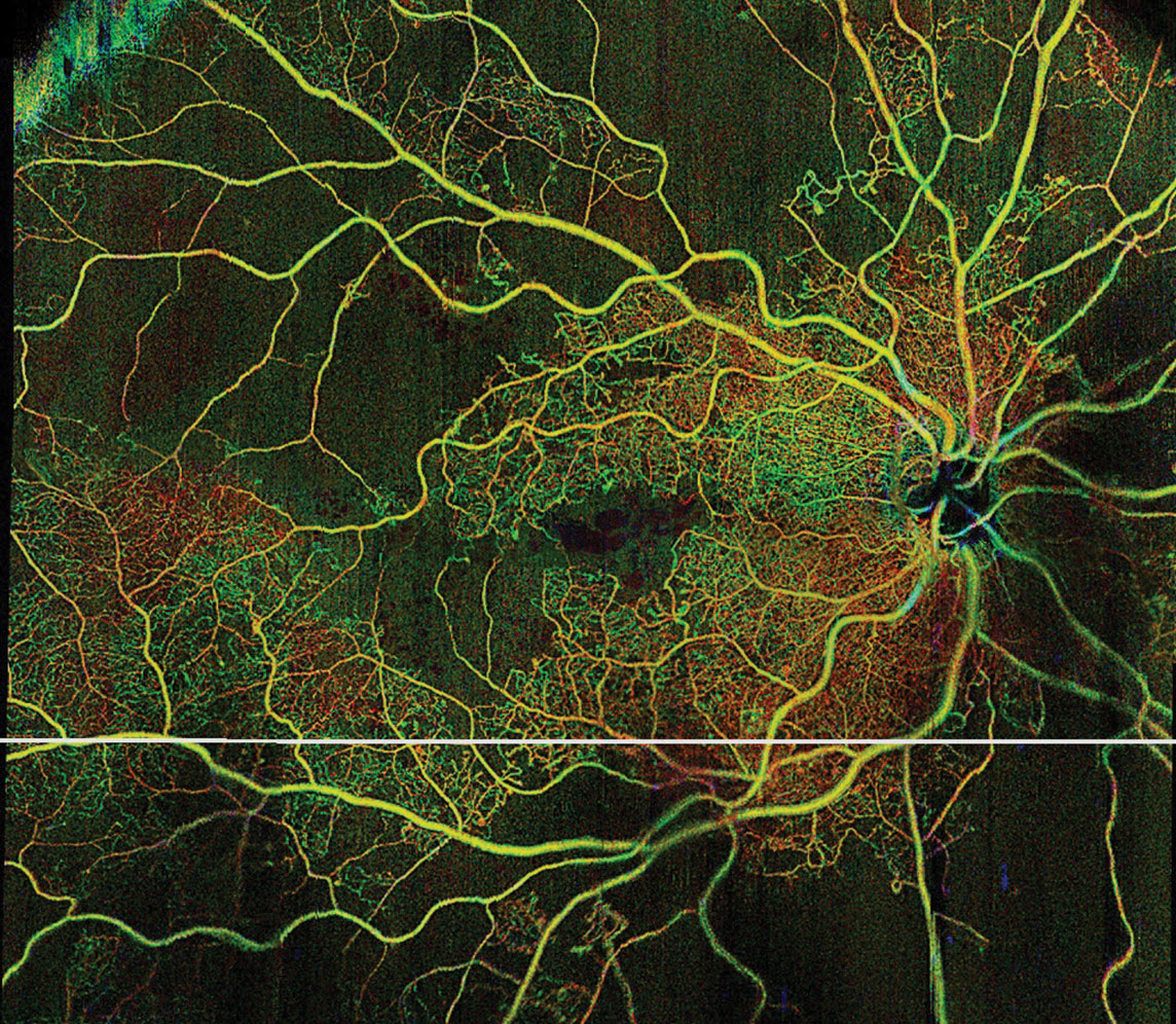 Vitrectomy for Diabetic Retinopathy: Think Early, Not Late - Retina Today