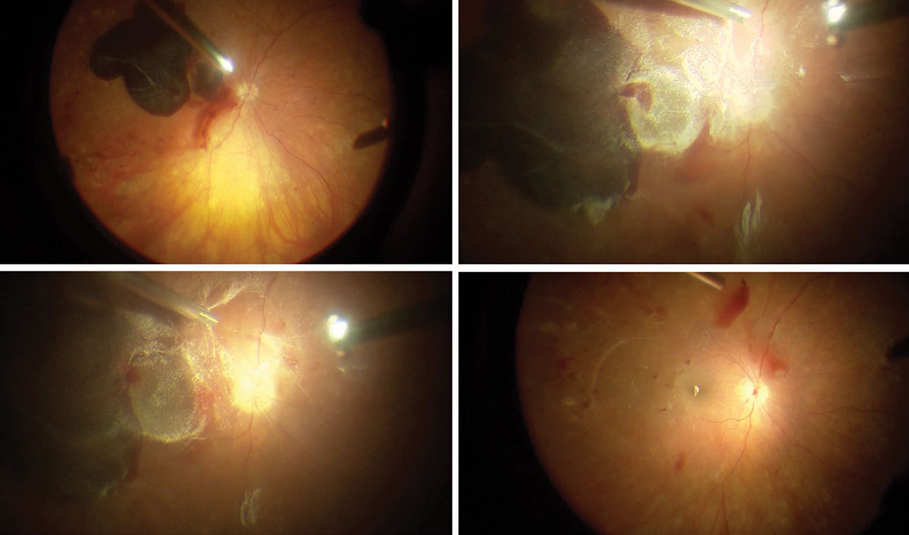 Vitrectomy for Diabetic Retinopathy: Think Early, Not Late - Retina Today