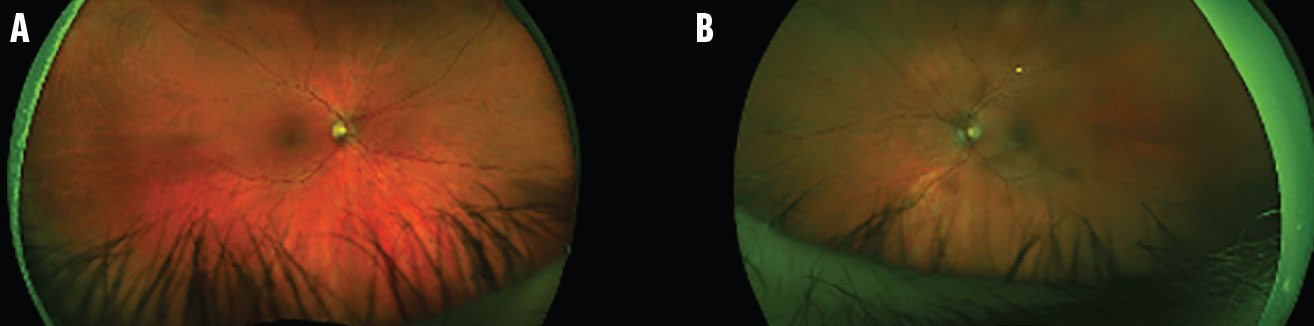 Workup and Management of Choroidal Folds - Retina Today