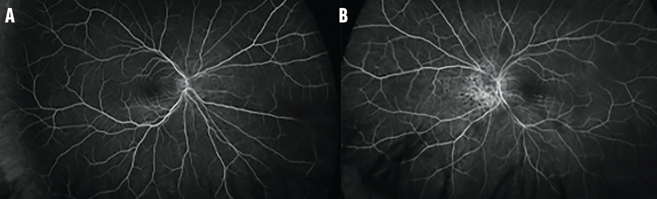 Workup and Management of Choroidal Folds - Retina Today