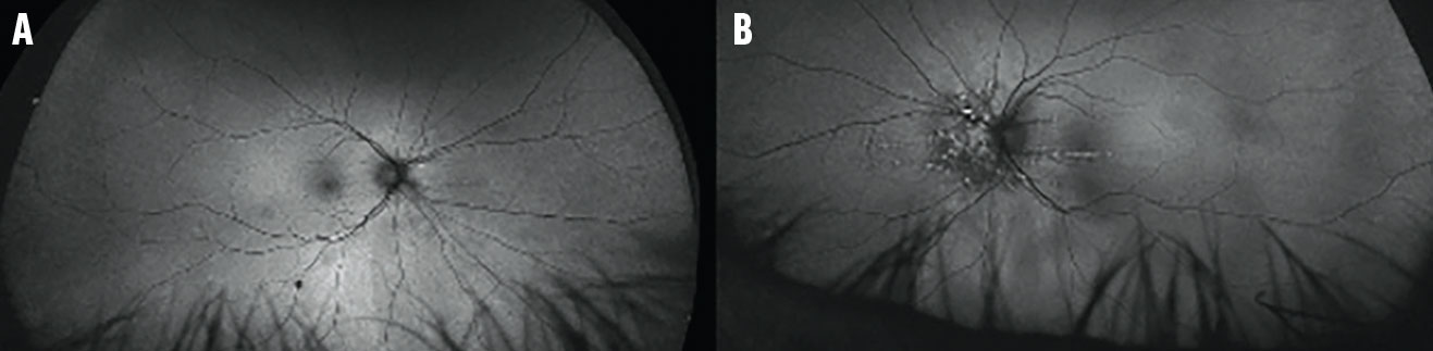 Workup and Management of Choroidal Folds - Retina Today