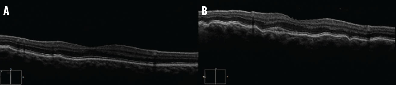 Workup and Management of Choroidal Folds - Retina Today