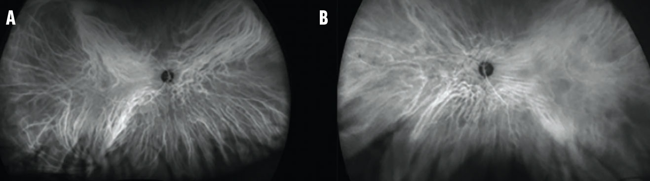Workup and Management of Choroidal Folds - Retina Today
