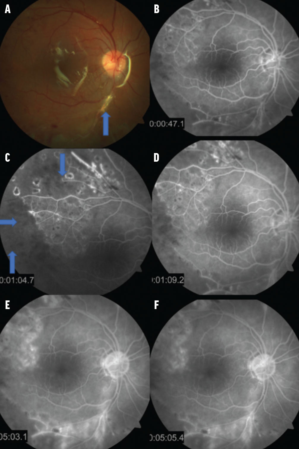 Managing The Ocular Effects of Steroid Overdose - Retina Today