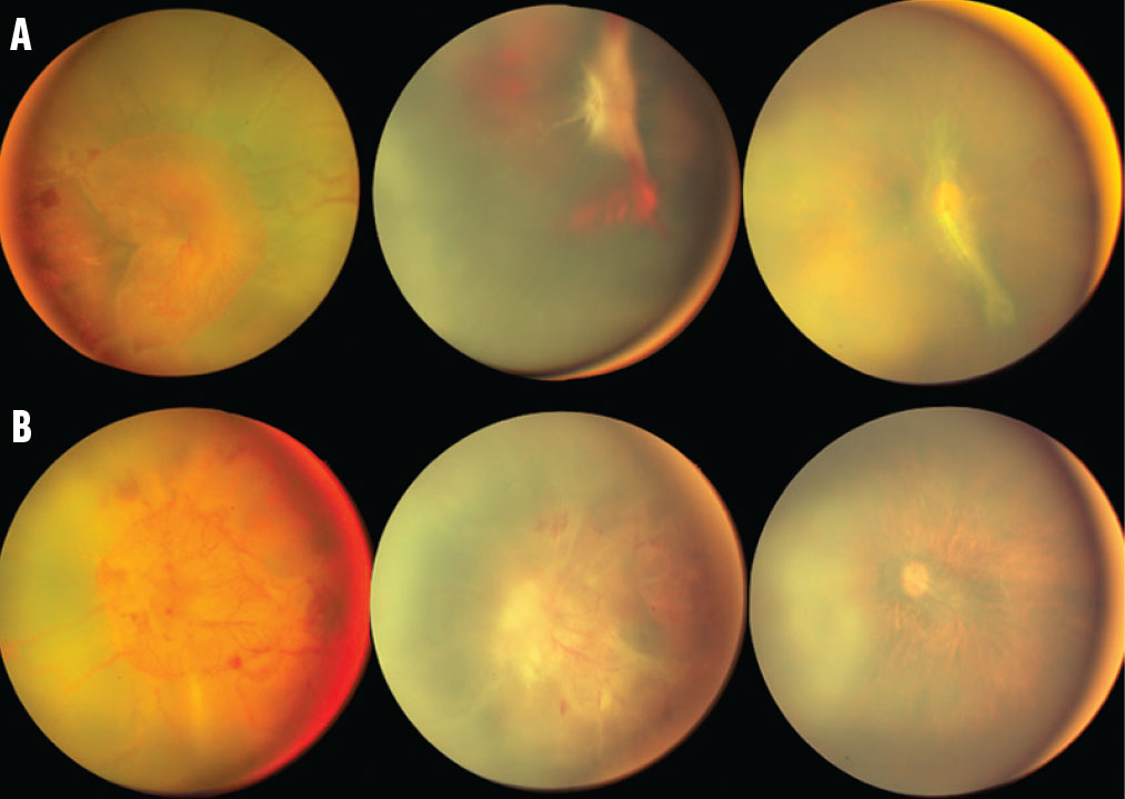 Pediatric Retina Cases and Conclusions - Retina Today