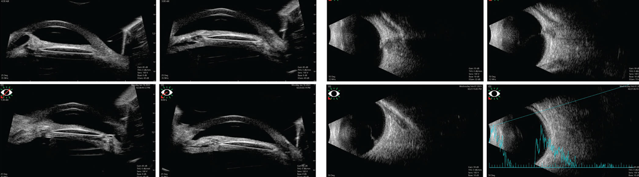 Pediatric Retina Cases and Conclusions - Retina Today