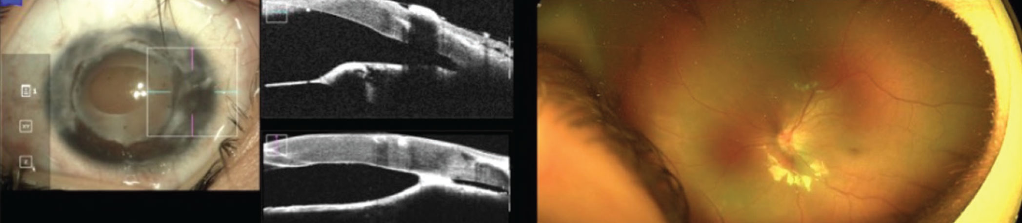 Pediatric Retina Cases and Conclusions - Retina Today