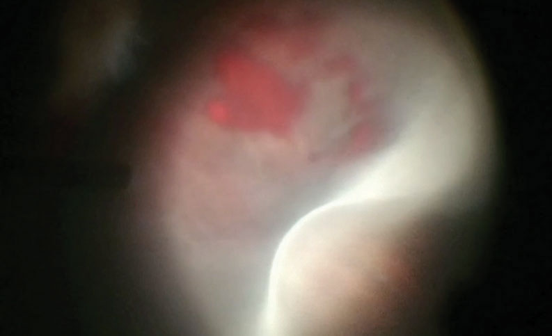 Pediatric Retina Cases and Conclusions - Retina Today