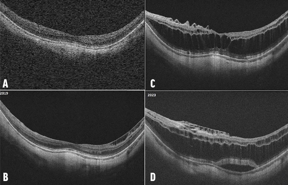 Myopic Traction Maculopathy in a Surgical Setting - Retina Today