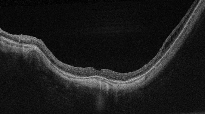 Myopic Traction Maculopathy in a Surgical Setting - Retina Today