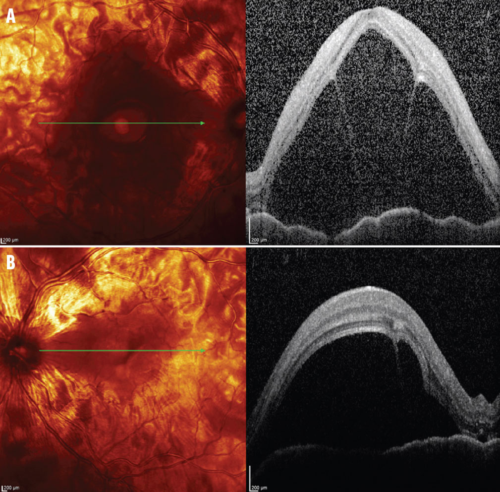 Ocular Toxicity of New-Age Cancer Therapies - Retina Today