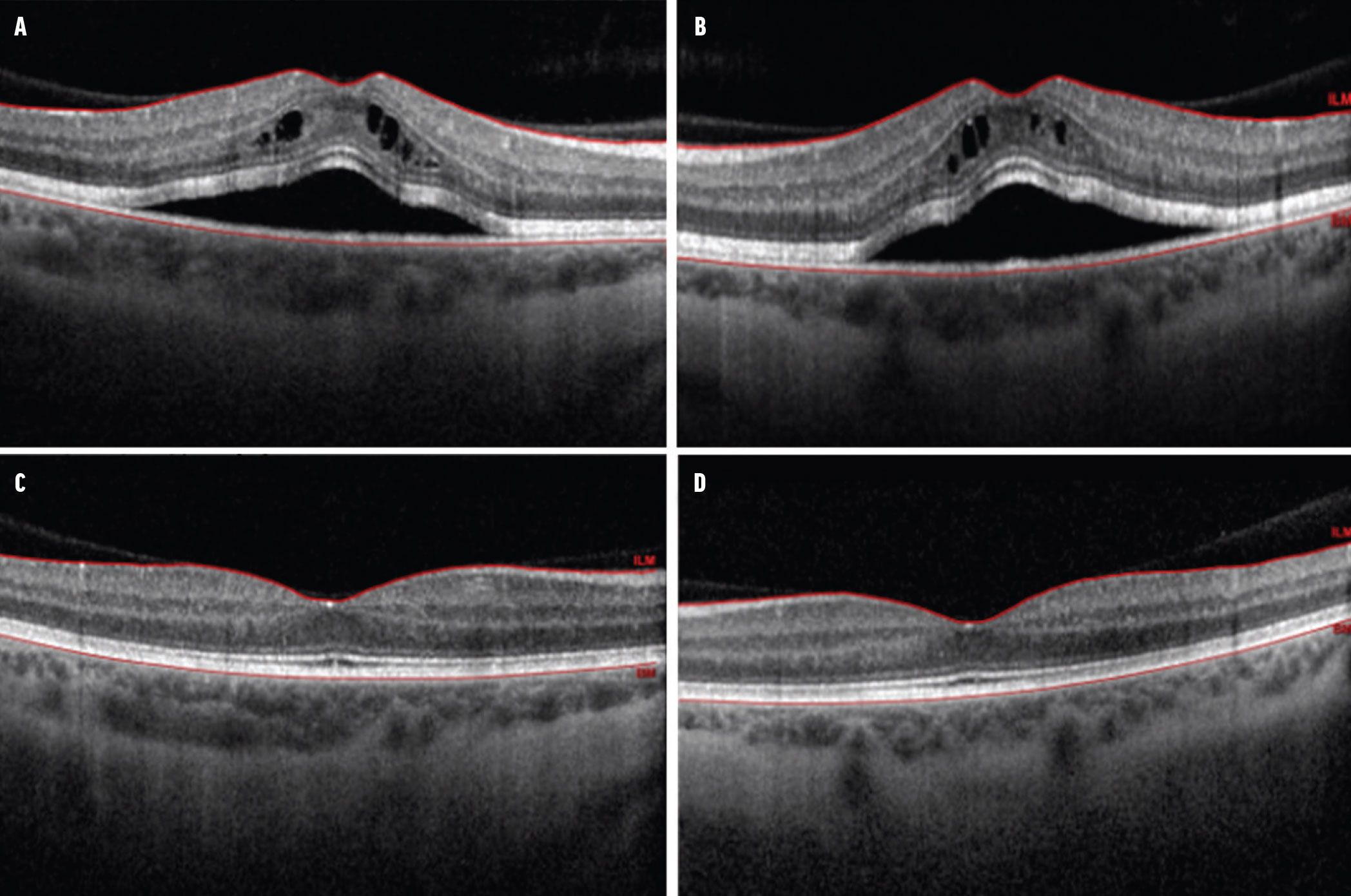 Ocular Toxicity of New-Age Cancer Therapies - Retina Today
