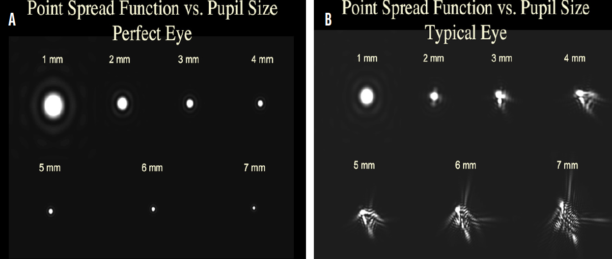 What Is the Optimal Pupil Size? - YoungMD Connect