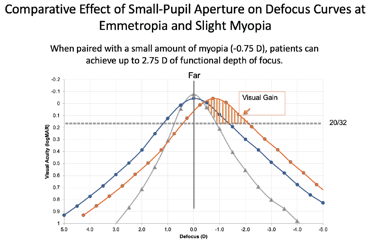 What Is the Optimal Pupil Size? - YoungMD Connect