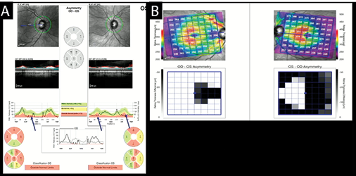 Screening and Establishing a Diagnosis With OCT - Glaucoma Today
