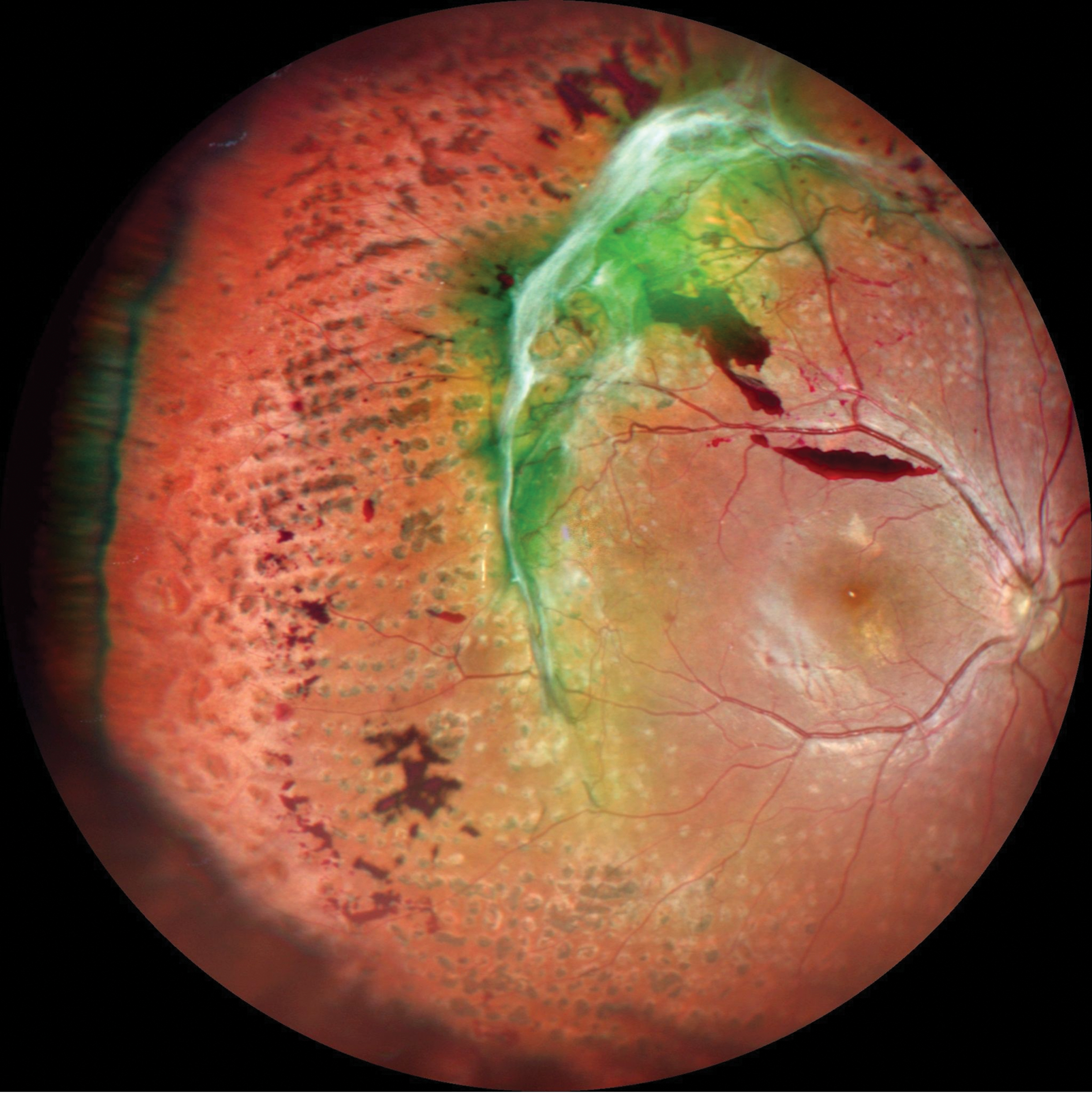 DIABETIC RETINOPATHY: 20/25, for How Long? - Retina Today