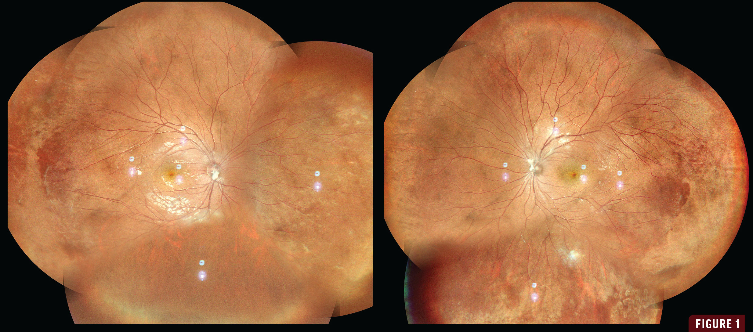 Catching Familial Exudative Vitreoretinopathy Early - Retina Today