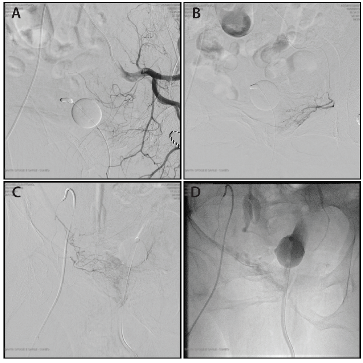 Prostate Artery Embolization - Endovascular Today