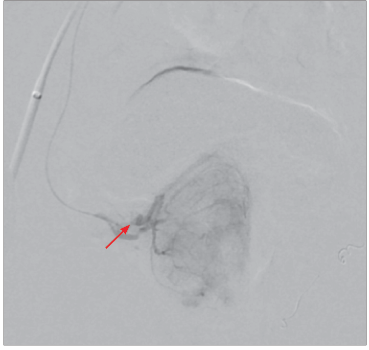 Prostate Artery Embolization* - Endovascular Today