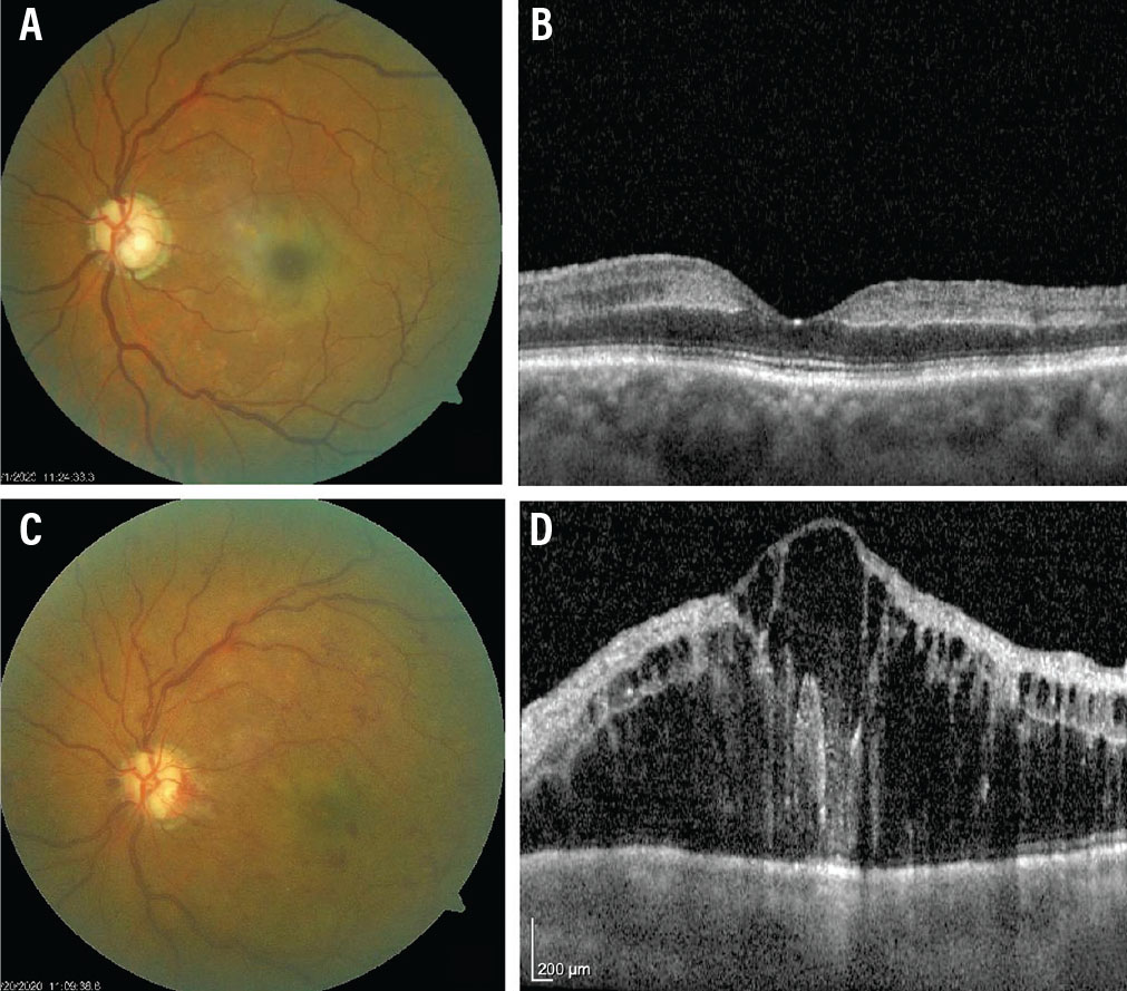 The Benefits of Identifying Paracentral Acute Middle Maculopathy ...