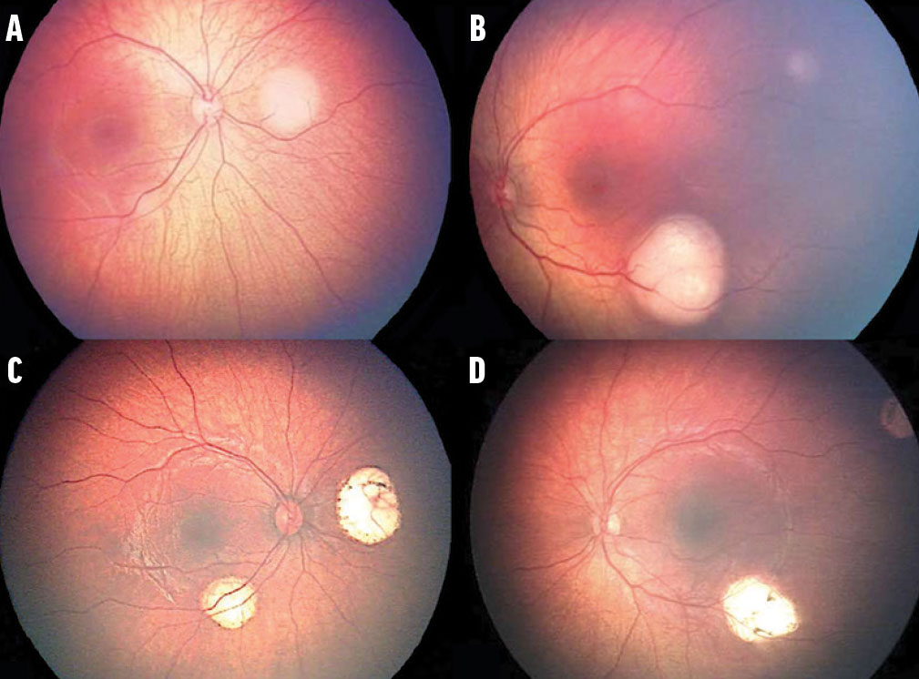 Trilateral Retinoblastoma with Suprasellar Mass - Retina Today