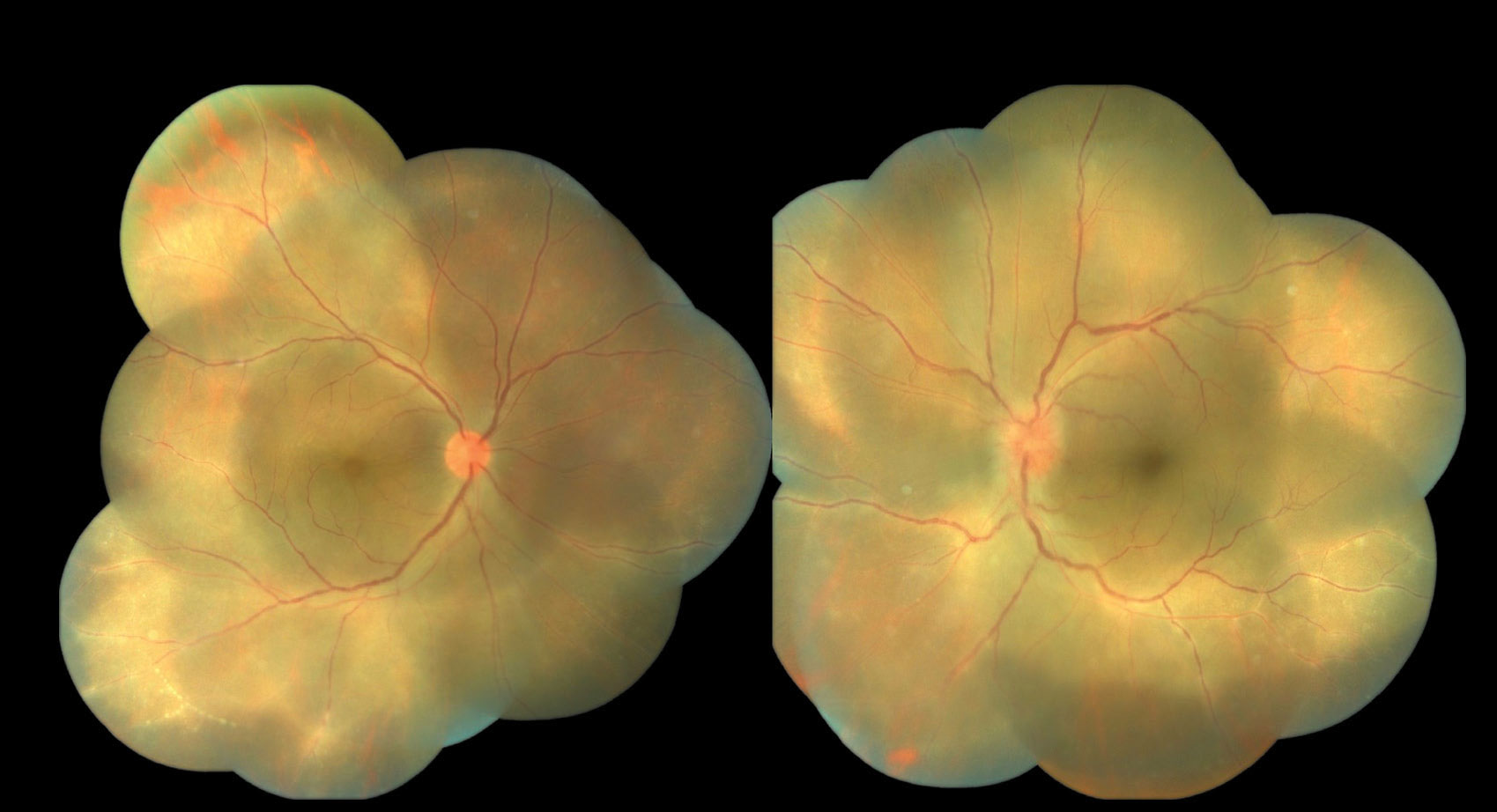 Dramatic Ocular Manifestations of an STD - Retina Today