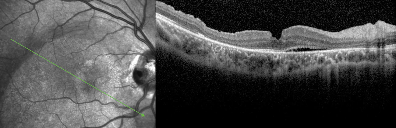 Tackling Pediatric Optic Disc Pit Maculopathy - Retina Today