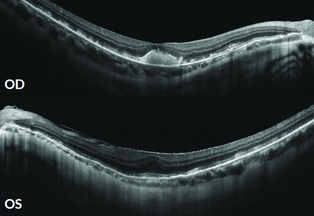 The Eye: A Window to the Heart - Retina Today