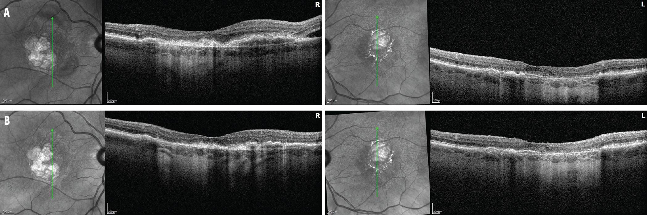Integrating Next-Generation Wet AMD Therapies - Retina Today