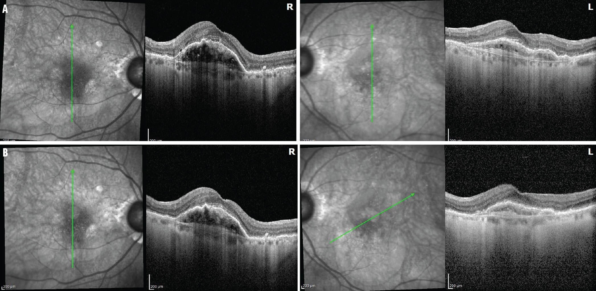 Integrating Next-Generation Wet AMD Therapies - Retina Today
