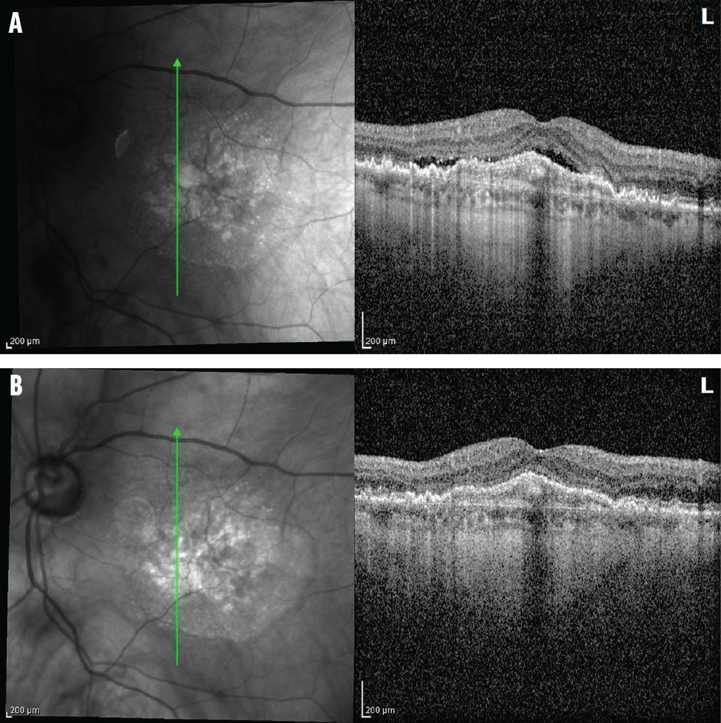 Integrating Next-Generation Wet AMD Therapies - Retina Today