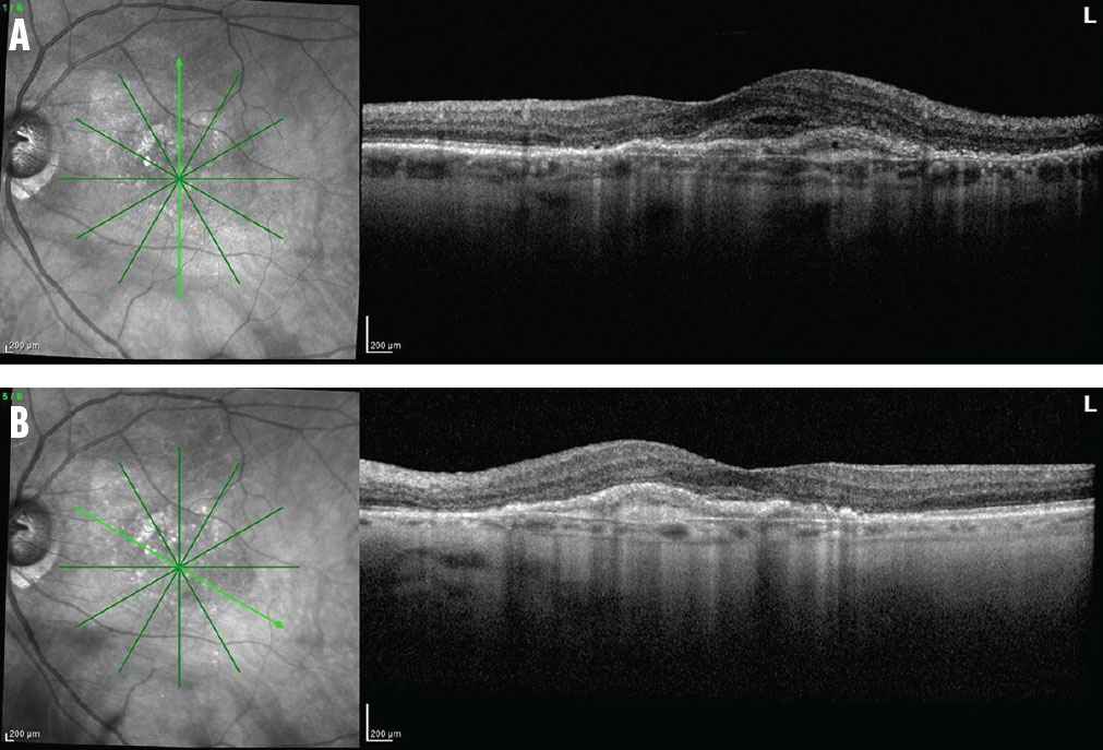 Integrating Next-Generation Wet AMD Therapies - Retina Today