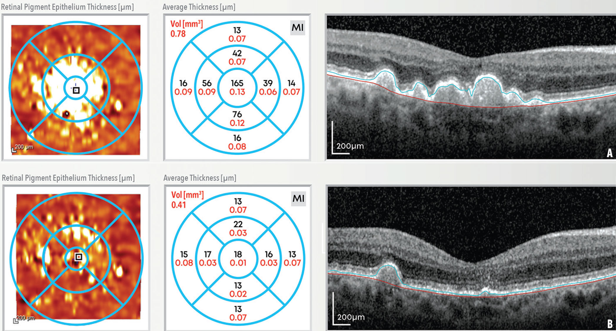 Photobiomodulation: Innovation on the Horizon for Dry AMD - Retina Today