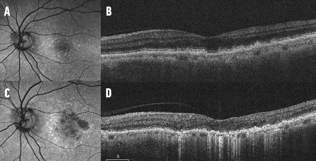 IOLs and AMD: The Current Landscape - Retina Today