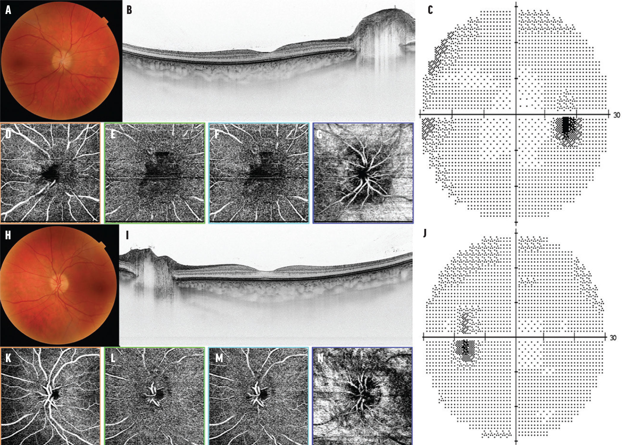 Evaluating the Threat of Bilateral Stasis - Retina Today