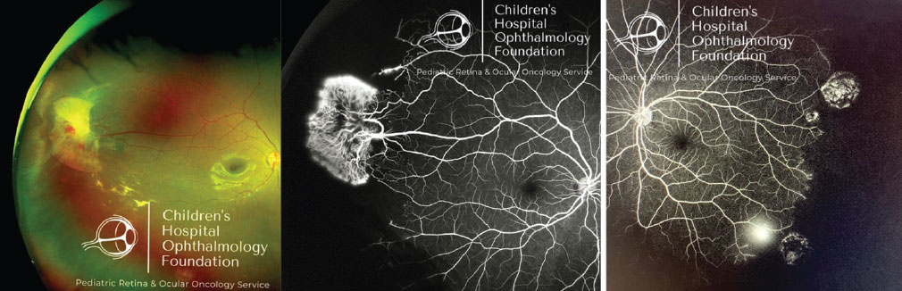Pediatric Retina Fellowship: A First of its Kind - Retina Today