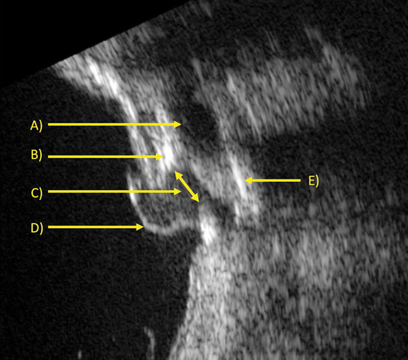 An Odd Case of Hypotony: The Value of Ultrasound - Retina Today