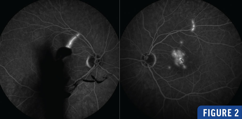 Self-Inflicted Laser-Induced Retinopathy - Retina Today