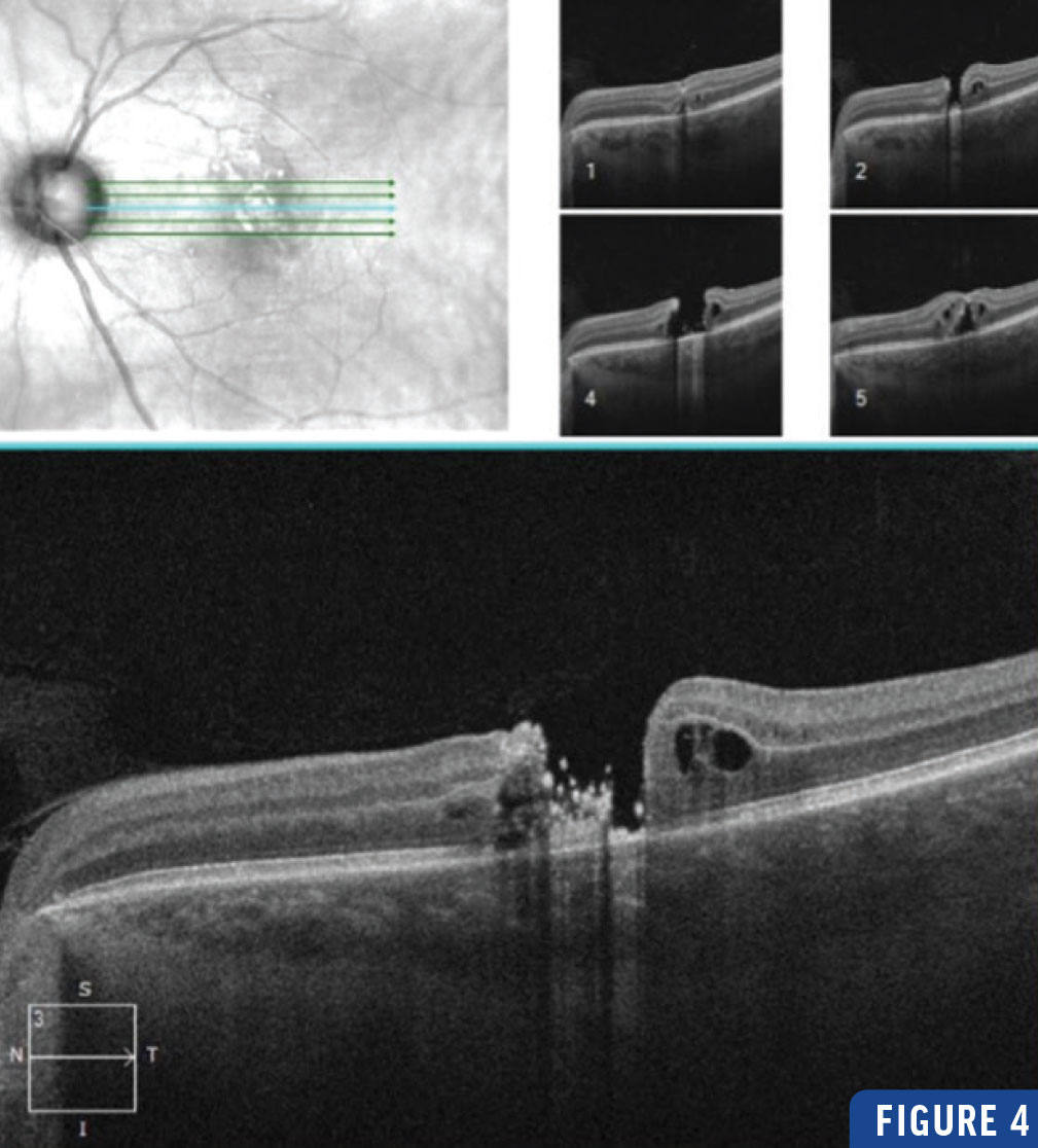 Self-Inflicted Laser-Induced Retinopathy - Retina Today