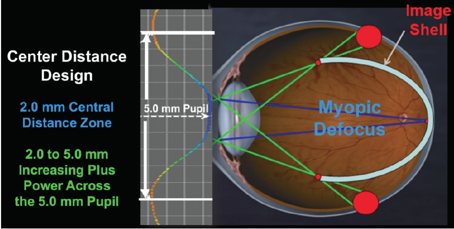 Myopia Control With Multifocal Contact Lenses Modern Optometry Myopia Control With Multifocal Contact Lenses Modern Optometry