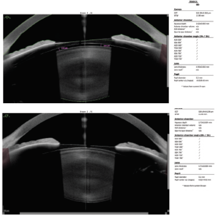 Decreasing Vaulting of a Phakic IOL - YoungMD Connect