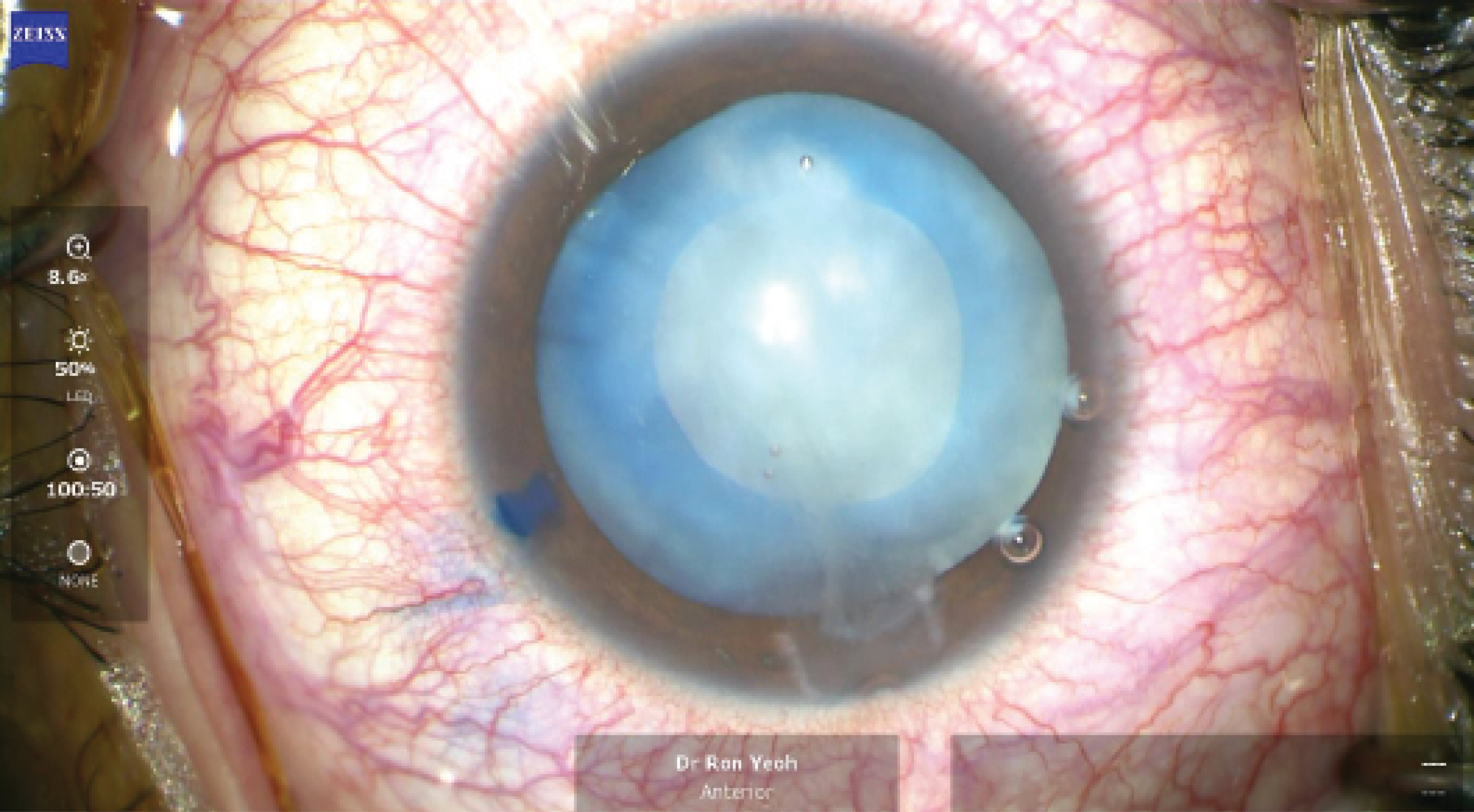 Laser Cataract Surgery for the Management of a White Cataract - YoungMD ...