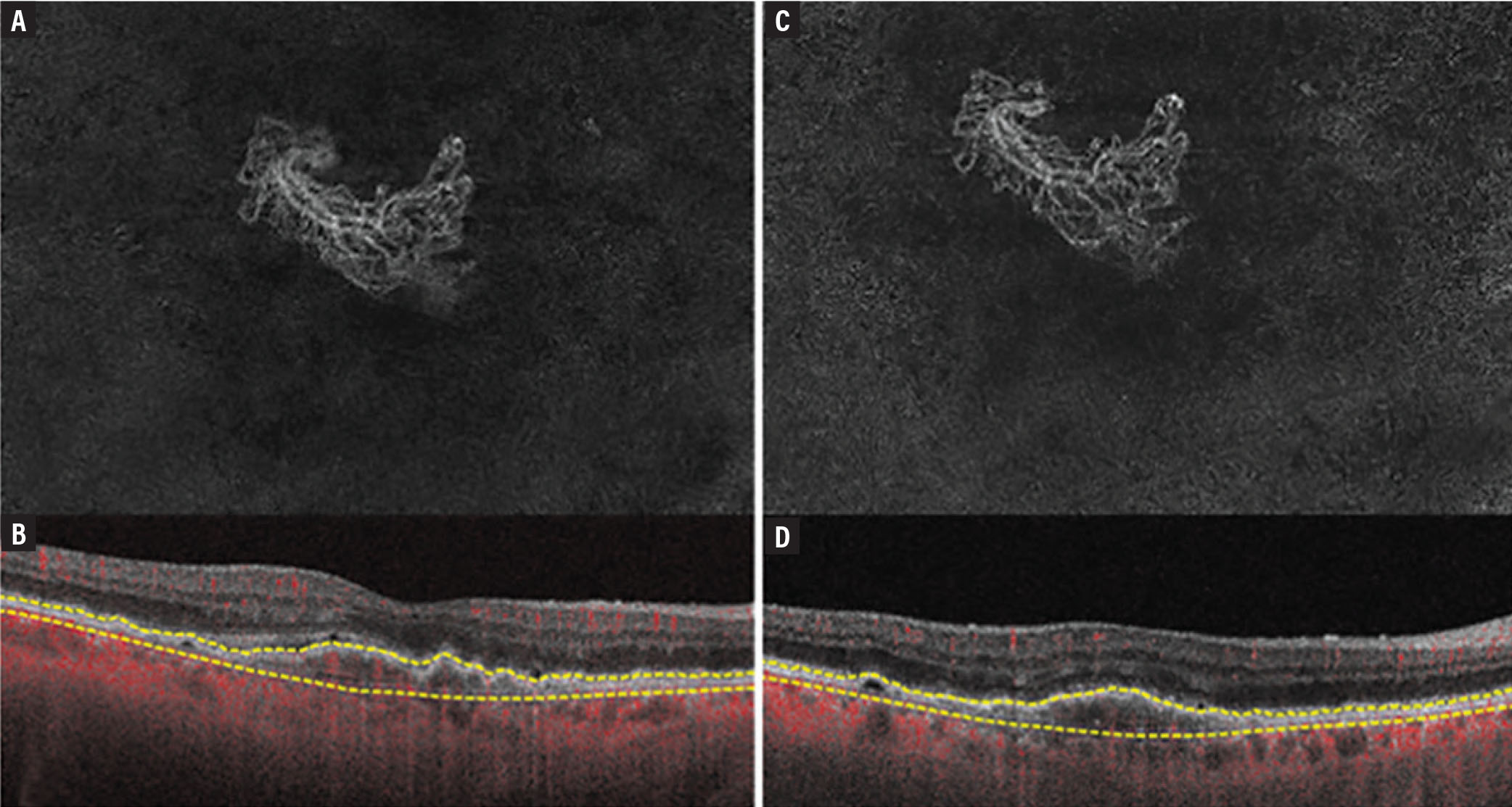 Clinical Utility of OCT Angiography for AMD - Retina Today